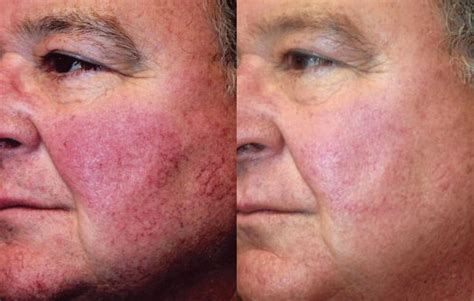 Does Red Light Therapy Cause Hyperpigmentation Friendredlight