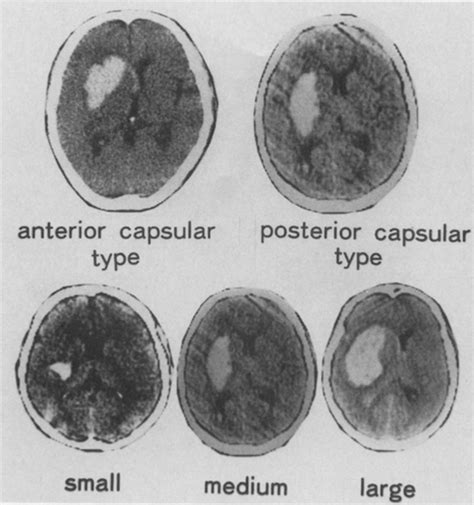 Indications For Surgical Treatment Of Putaminal Hemorrhage In Journal