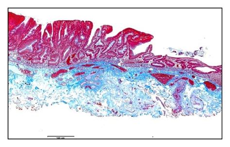 Sections Of Laterally Spreading Tumor Nongranular Lst Ng Type With