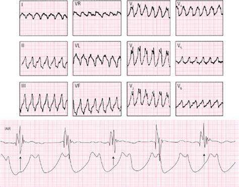 12 Ecg Patterns Of Ventricular Arrhythmias Thoracic Key