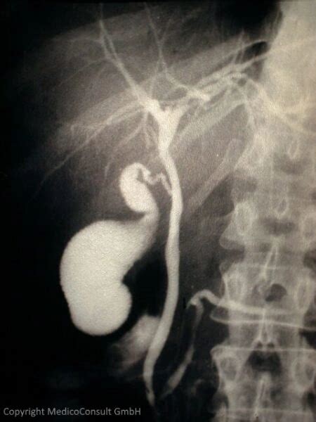 Ercp Normal 02 Mc Facharztwissen