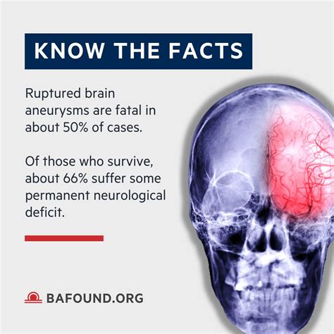 Brain Aneurysm Foundation On Linkedin Accurate Early Diagnosis Of A