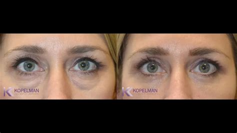 Eyelid Surgery Scars Healing Tips And Reducing Visibility