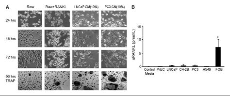 Figure 1 From Monocyte Chemotactic Protein 1 Mediates Prostate Cancer Induced Bone Resorption