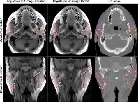 Segmentation Of Parotid Glands From Registered Ct And Mr Images Pmc
