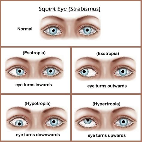 Squint And Paediatric Eye Disorders Jaya Eye Care Centre Is An Nabh