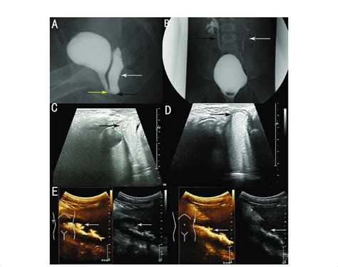 Preoperative Imaging Examinations A Voiding Cystourethrography