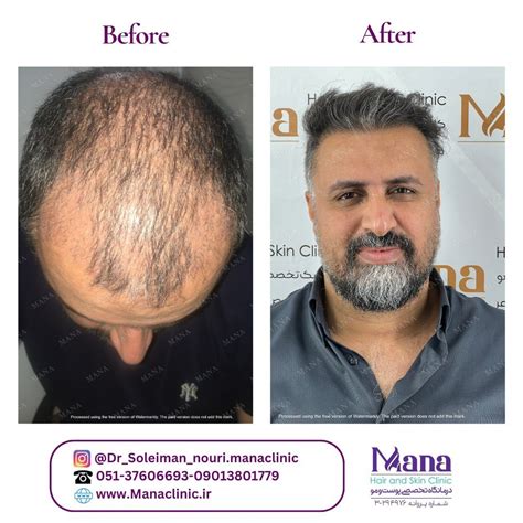 کاشت مو ️ کلینیک تخصصی پوست و مو مانا