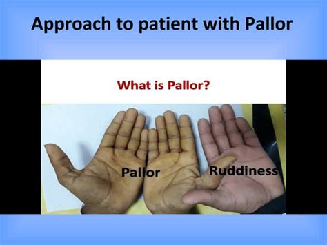 Approach To Pallor Full Compilationpptx