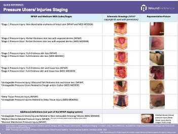 Pressure Ulcer Staging Guide Pressure Management Guide