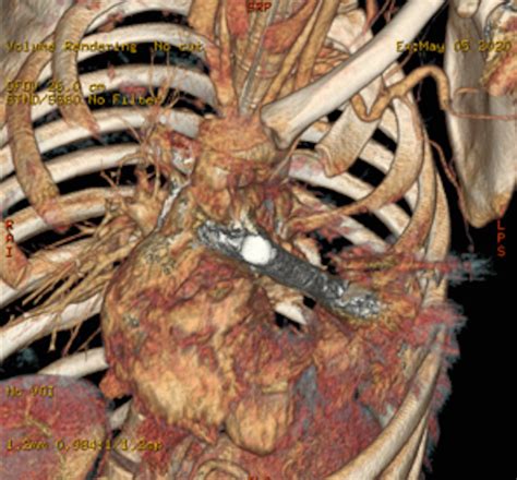 three‐dimensional 3d volume rendering of chest computed tomography