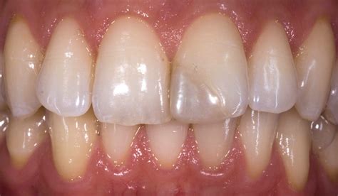 How To Do Class 4 Composite Restoration At Jessica Terrill Blog