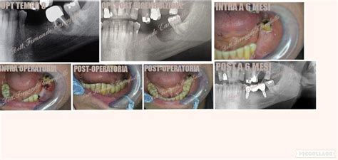 Critical Bone Defects Regeneration And Two Implant Placement After Six
