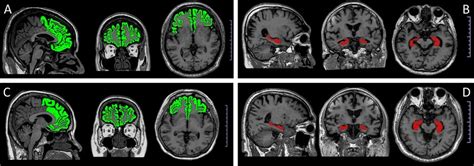 Orbitofrontal Cortex Mri Scielo Brasil Frontopolar And Anterior