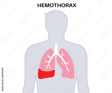 Hemothorax Medical Illustration Blood Accumulation In The Lung