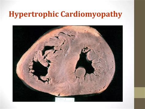 Hocm Hypertrophic Cardiomyopathy Ppt