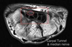Carpal Tunnel Syndrome Surgery And Treatment Cape Town