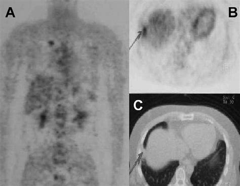 A Uptake Suggestive Of Malignancy In The Previous Bullectomy Site Of