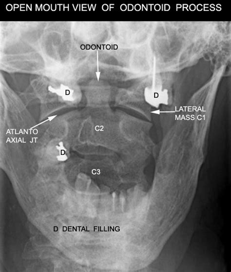 Odontoid Process Fuchs View Through The Open Mouth Human Anatomy