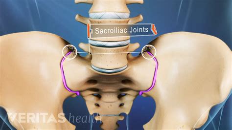 Sacroiliac Joint Dysfunction Si Joint Pain