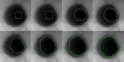 Evolution Of The Active Contour With 300 Iterations On The Lesion Roi