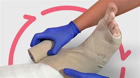 Is An Unna Boot The Right Choice To Treat Venous Leg Ulcers
