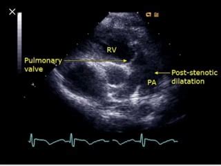 Pulmonary Stenosis Presentation Pptx
