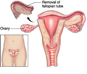 Cancer Of The Fallopian Tubes Cancers Of The Female Reproductive System