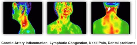Thermography Images Florida Medical Thermography June Drennon