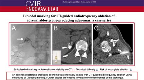 Lipiodol Marking For Ct Guided Radiofrequency Ablation Of Adrenal
