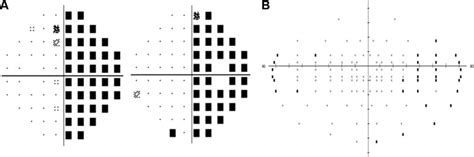 Example Of How An Ipsilateral Exotropia Can Extend The Usable Visual