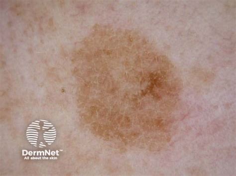 Solar Lentigo Dermoscopy Image