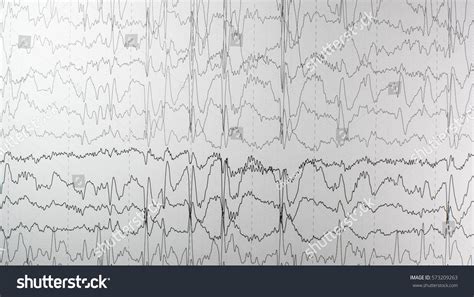 Epilepsy Brain Waves