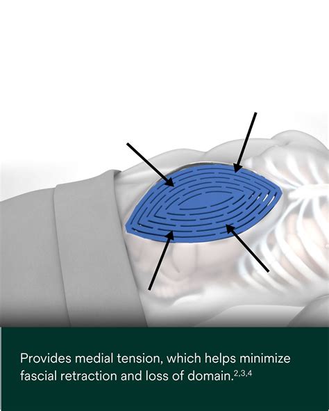 3m™ Abthera™ Advance Open Abdomen Dressing