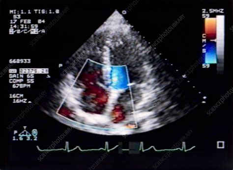 Doppler Echocardiogram Of Heart Stock Image M4060319 Science
