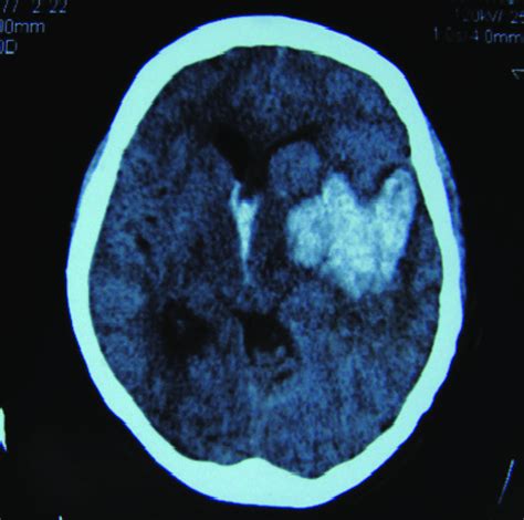 Non Contrast Ct Scan Shows A Spontaneous Hyperdensity Of The Right