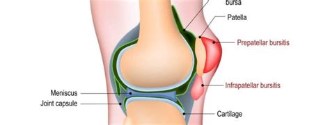 What Is Knee Bursitis Orthopaedics Toronto Orthoto