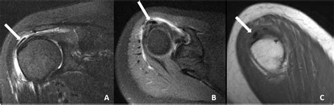Mri In Shoulder Arthropathies A Short Review Journal Of Clinical