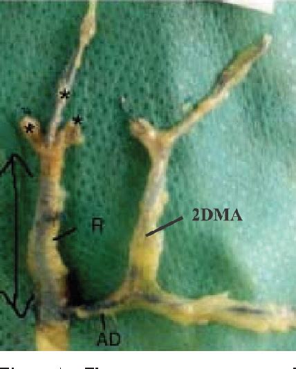 Structure Of Dorsal Metacarpal Artery Semantic Scholar