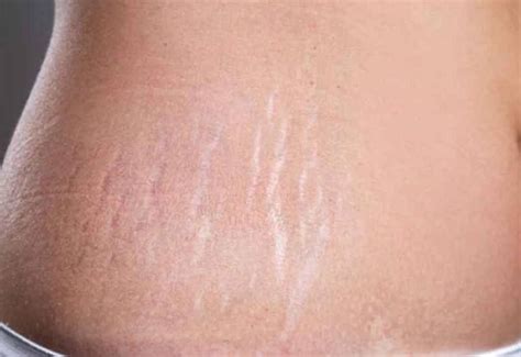 How To Get Rid Of Stretch Marks With Microneedling Diaminyaesthetics