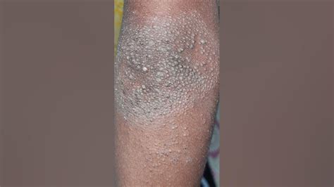 Phrynoderma 😱 Shorts Shortsfeed Shortsvideo Doctorskin Youtube