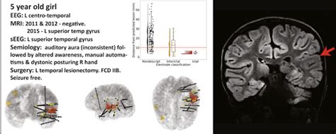Planning Seeg Using Automated Lesion Detection Meld Project Planning Seeg Using Automated Lesion Detection Meld Project