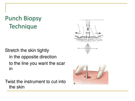 Punch Biopsy Psoriasis At Ruby Najar Blog