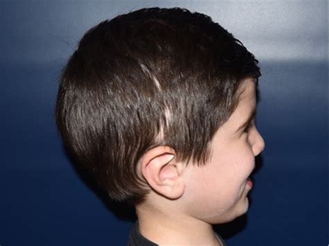 Craniosynostosis Before And After Photos By Rachel Ruotolo Md