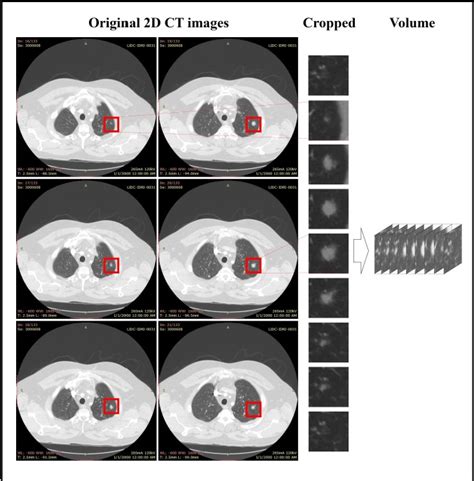 Table From Solitary Pulmonary Nodule Malignancy Classification Utilising D Features And Semi