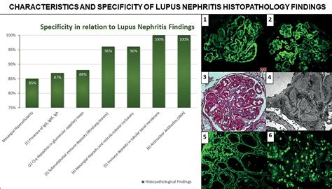 Brasil Pediatric Lupus Nephritis Pediatric Lupus Nephritis