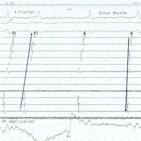 B The Electrophysiology Trace Showing The Reversion Of Atrial Flutter Download Scientific
