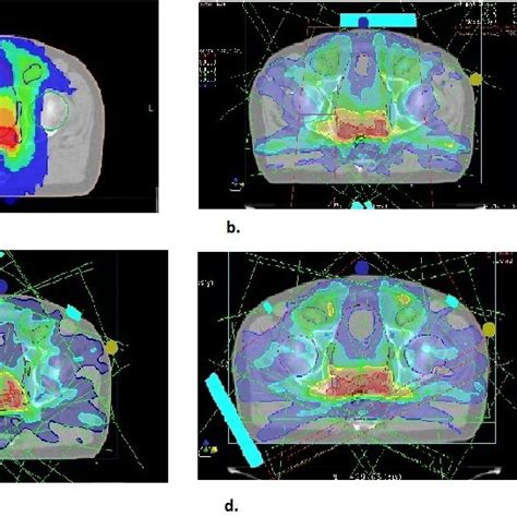 A Axial View Of Dose Distributions For Helical Tomotherapy B Axial Download Scientific