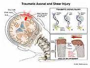 Shear And Diffuse Axonal Injury Medical Exhibits