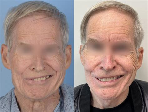 Patient 325355 Denervation Before And After Photos Hadlock Facial